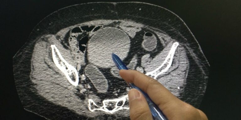 Which Cancers Can a Pelvic CT Scan Detect? | American Health Imaging