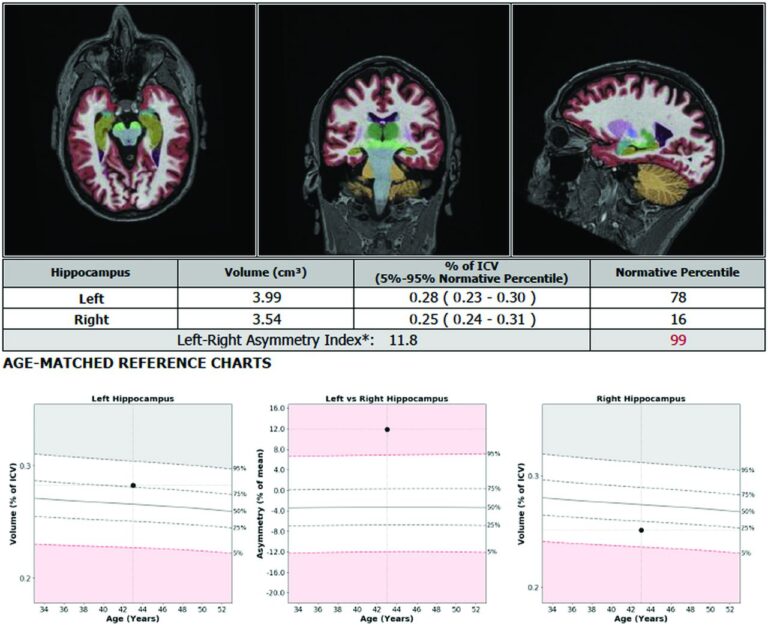 Understanding NeuroQuant • American Health Imaging