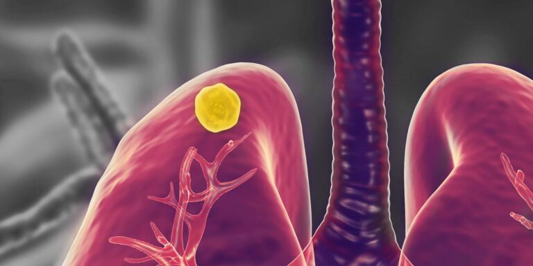 What Is a Lung Nodule? • American Health Imaging