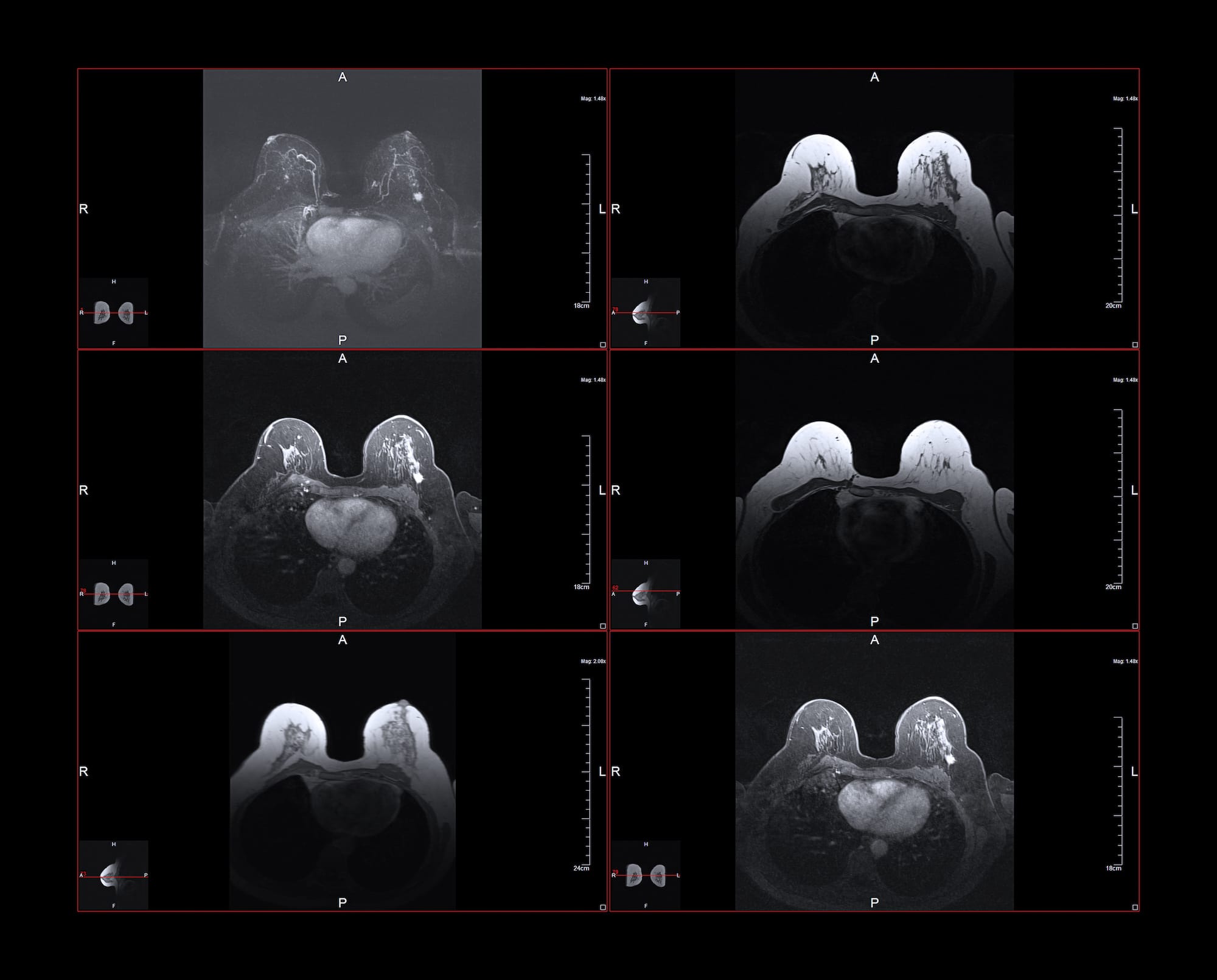 Accelerated Breast MRI • American Health Imaging • Dense Breast Scan