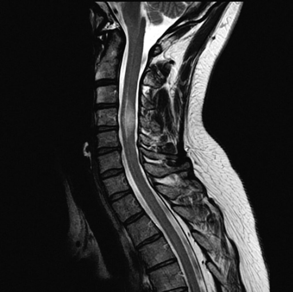 Myelogram Spinal Imaging • American Health Imaging • X-Ray
