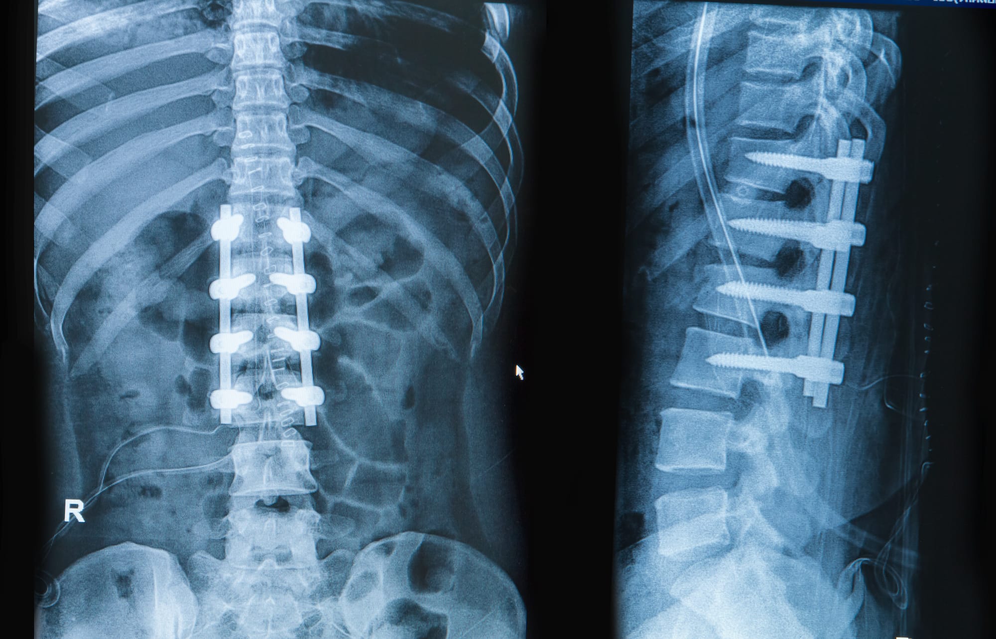 Myelogram Spinal Imaging • American Health Imaging • X-Ray