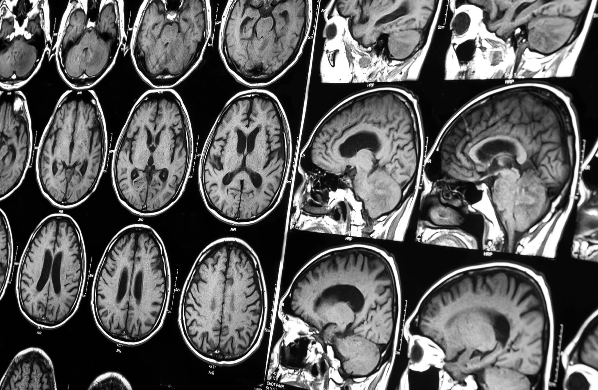 Diffusion Tensor Imaging MRI Scan • American Health Imaging