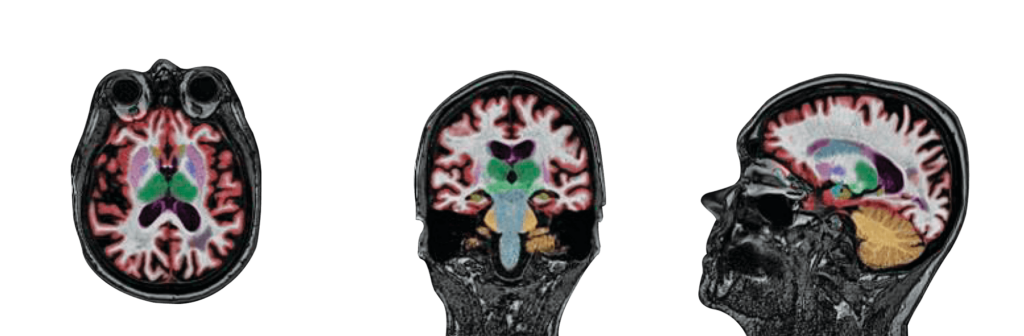 NeuroQuant® Brain Imaging • American Health Imaging