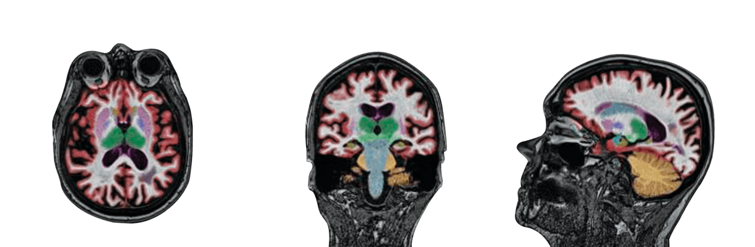 NeuroQuant® Brain Imaging • American Health Imaging