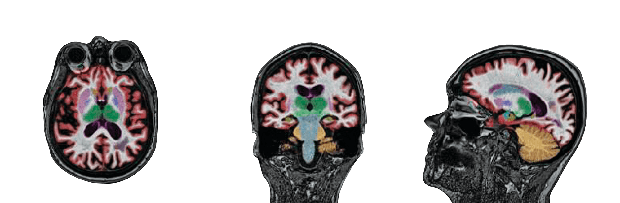 NeuroQuant® Brain Imaging • American Health Imaging