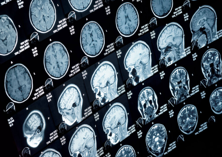 NeuroQuant® Brain Imaging • American Health Imaging
